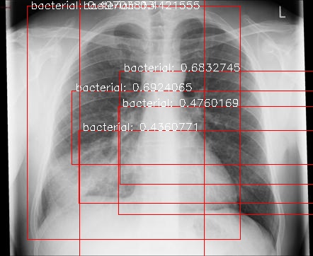GitHub - danielfleury/Pneumonia-Object-Detection-Web-App ...