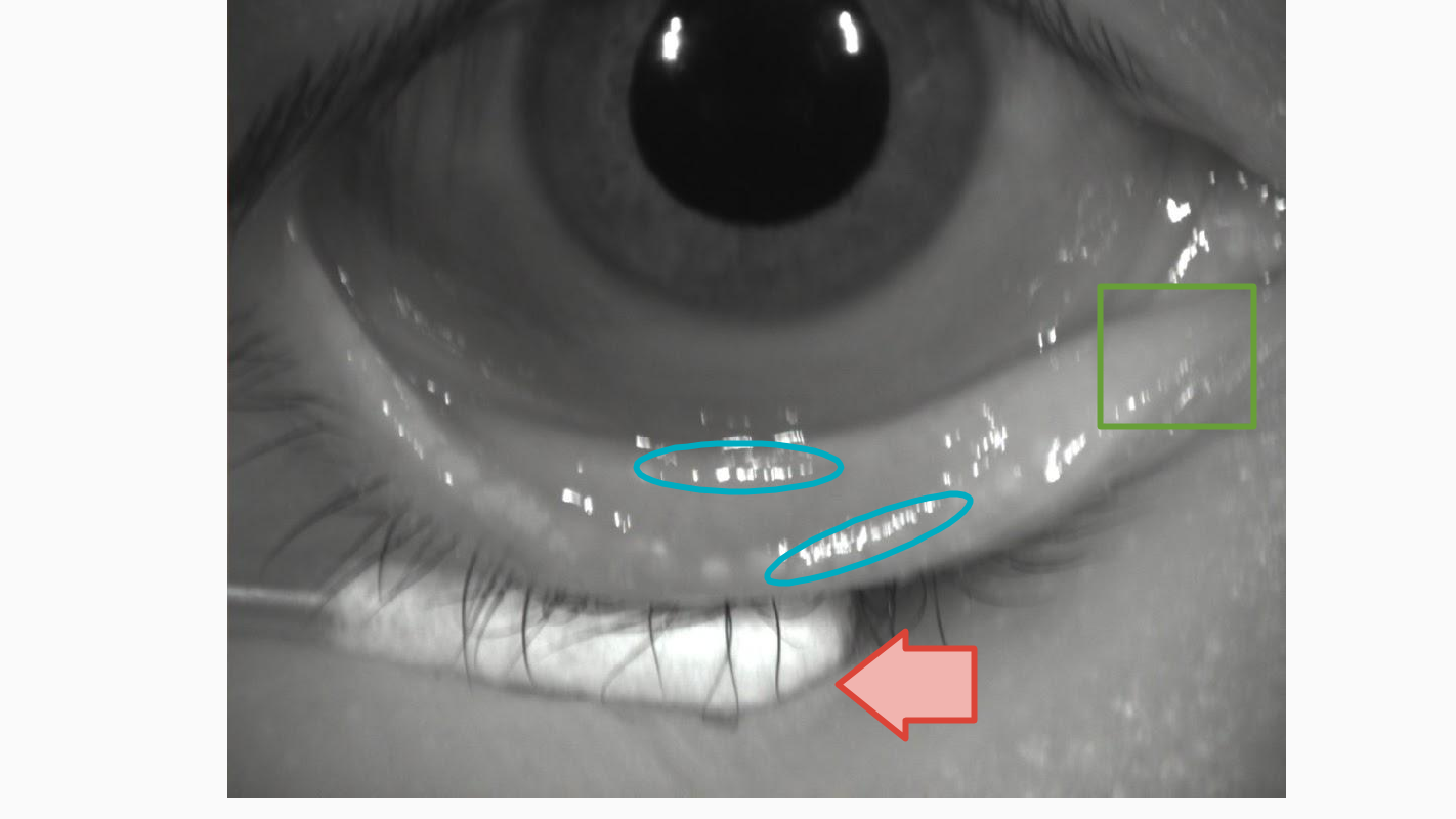 Meibomian-Gland-Dysfunction/SegmentaParpado.m at master · ldelaoa/Meibomian-Gland-Dysfunction ...