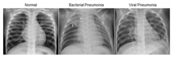 GitHub - tthien92/three_way_pneumonia_classification