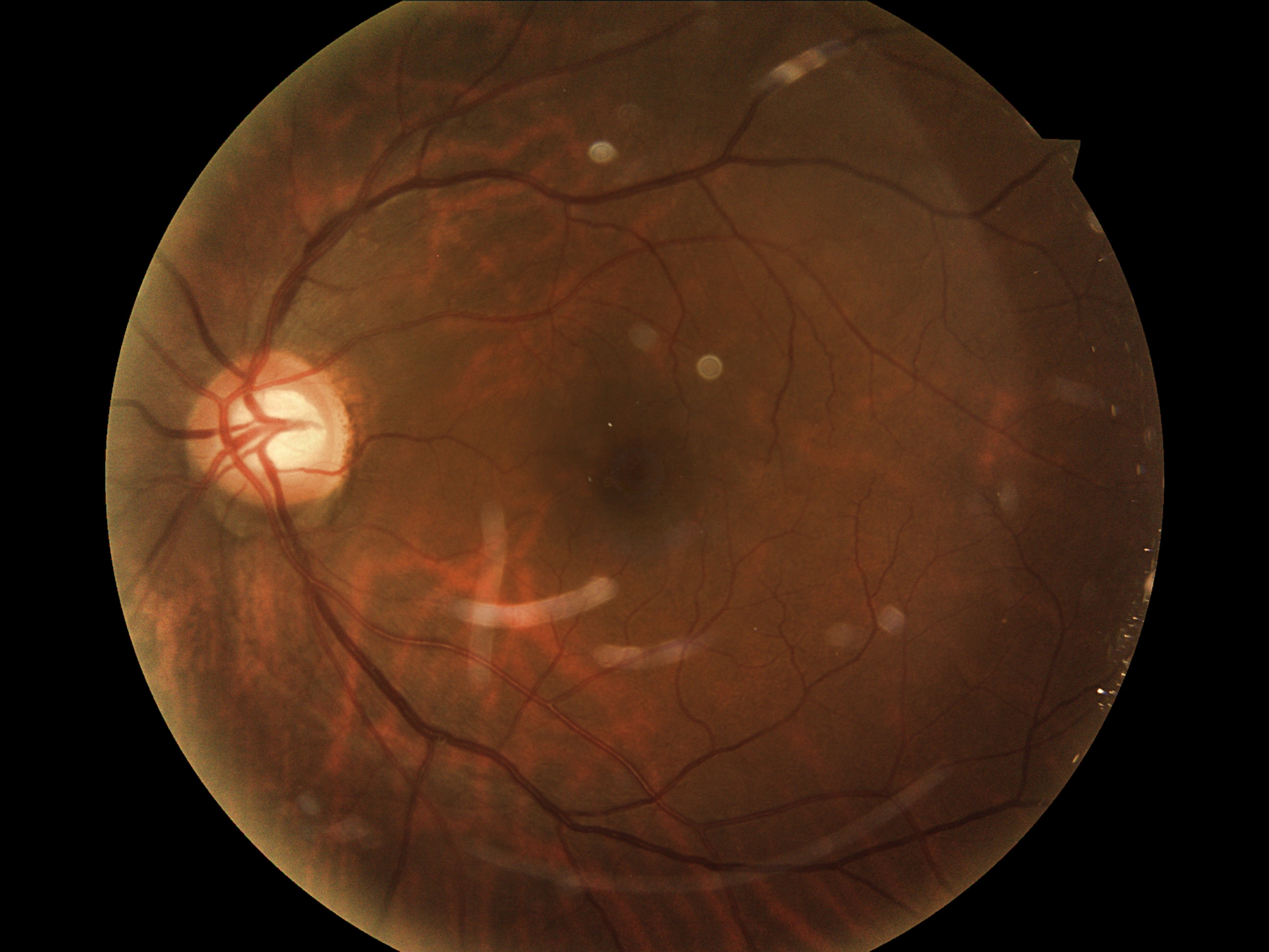 GitHub - Aishuvenkat09/Diabetic-Retinopathy-Detection