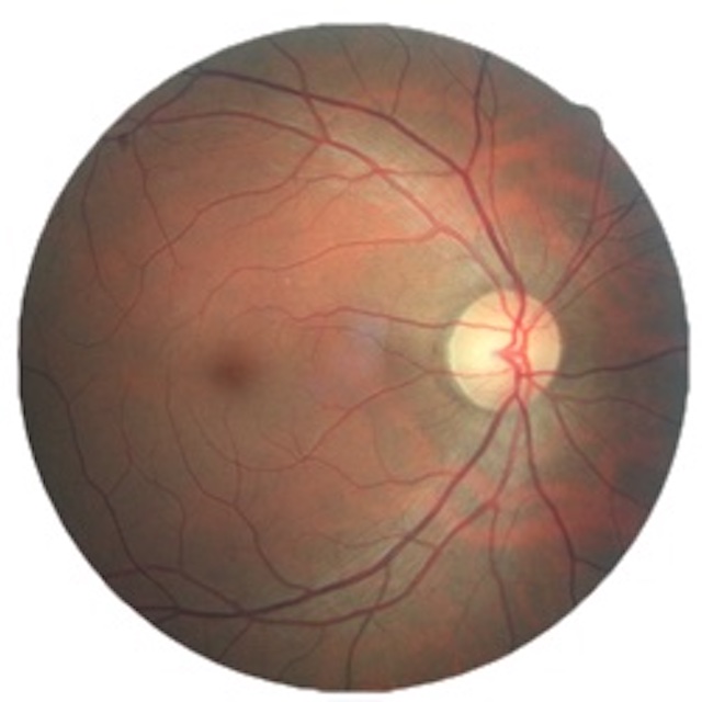 diabetic-retinopathy/Diabetic-Retinopathy-512-Classification-Copy6.ipynb at master · luigisaetta ...