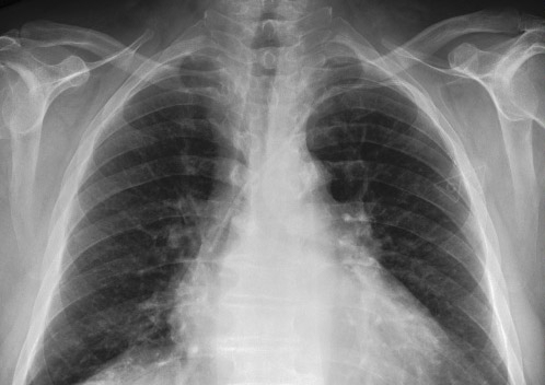 Chest_X-Ray-Image_Classification/Chest_X-ray_cnn.h5 at main · Ericusick/Chest_X-Ray-Image ...