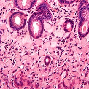 GitHub - AashikSharif/Histopathological_Cancer_Detector: Deep Learning ...