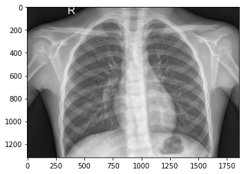 GitHub - prashun07/Detecting-pneumonia-from-chest-X-ray