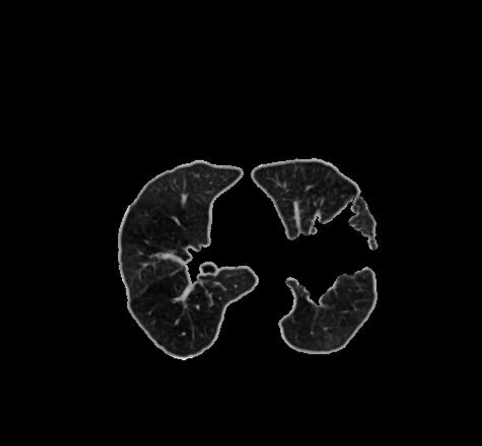 Github Fanconic Colon Cancer Segmentation Colon Cancer Segmentation