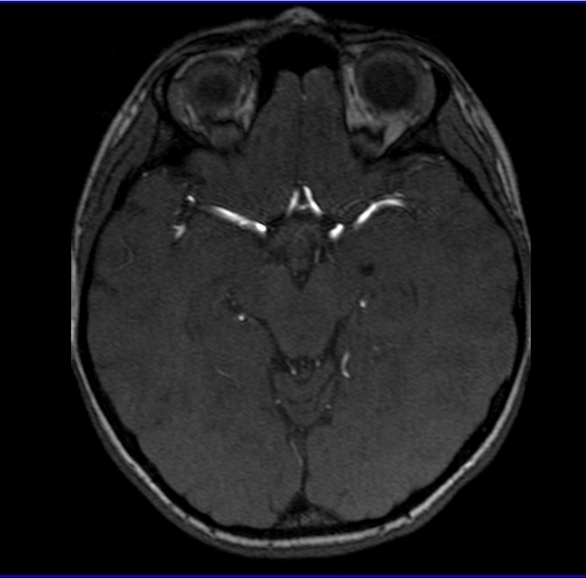 GitHub - wielandmichele/TOF-MRA-images: Bachelor thesis on "Leveraging 3D CNNs for predicting ...