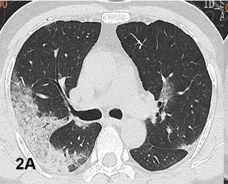 GitHub - K-Mahfoudh/Covid-19-Detection-CTScans: Detecting covid-19 on CT-Scans using CNNs