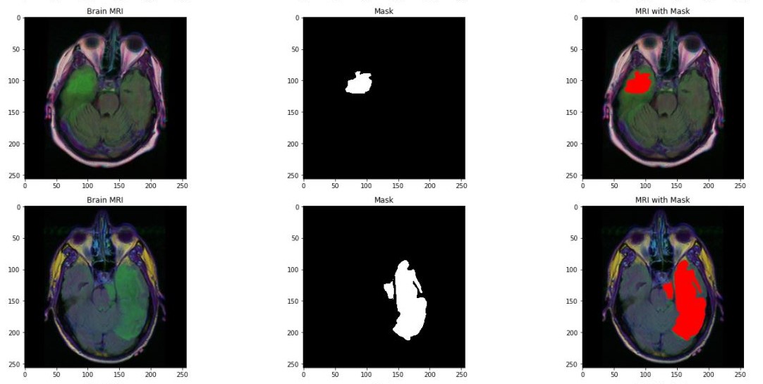Github Sachinkavindaa Physics Brain Tumour Segmentation Project