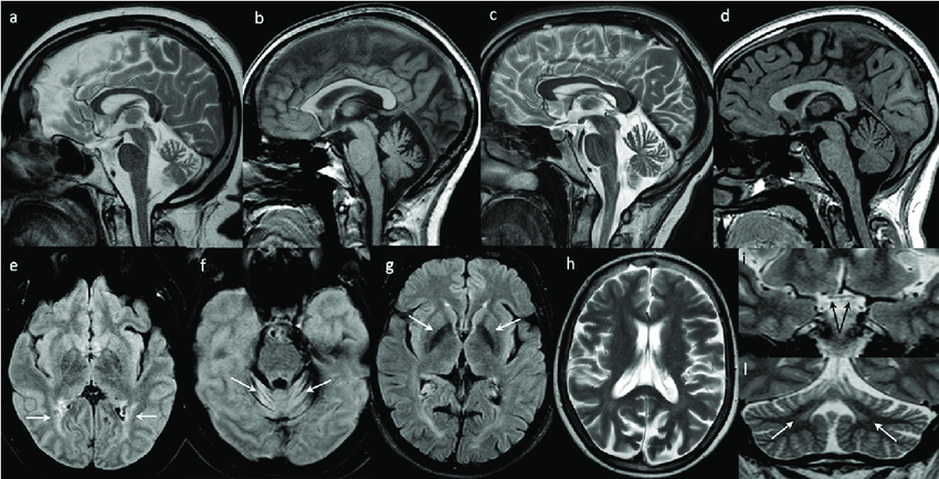 GitHub - SowatRafi/Lossless-Segmentation-of-Brain-Tumors-from-MRI ...