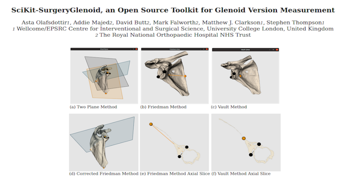 GitHub - SciKit-Surgery/scikit-surgeryglenoid-paper: A paper describing scikit-surgeryglenoid