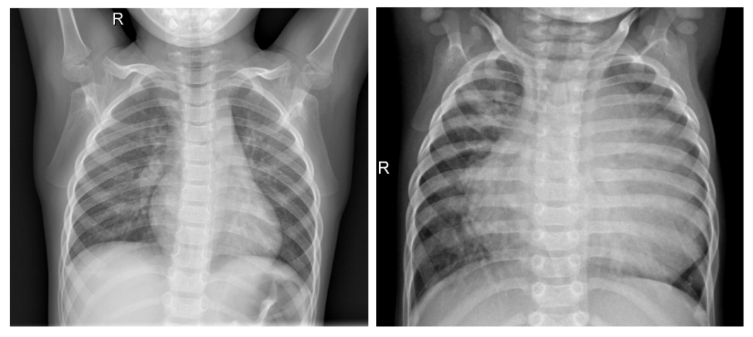 GitHub - nikoneri/CHEST_X-RAY_PNEUMONIA_CLASSIFICATION: The main goal ...