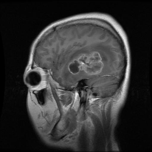 GitHub - LukasJM/Brain_tumor_classifier_CNN: Convolutional Neural ...