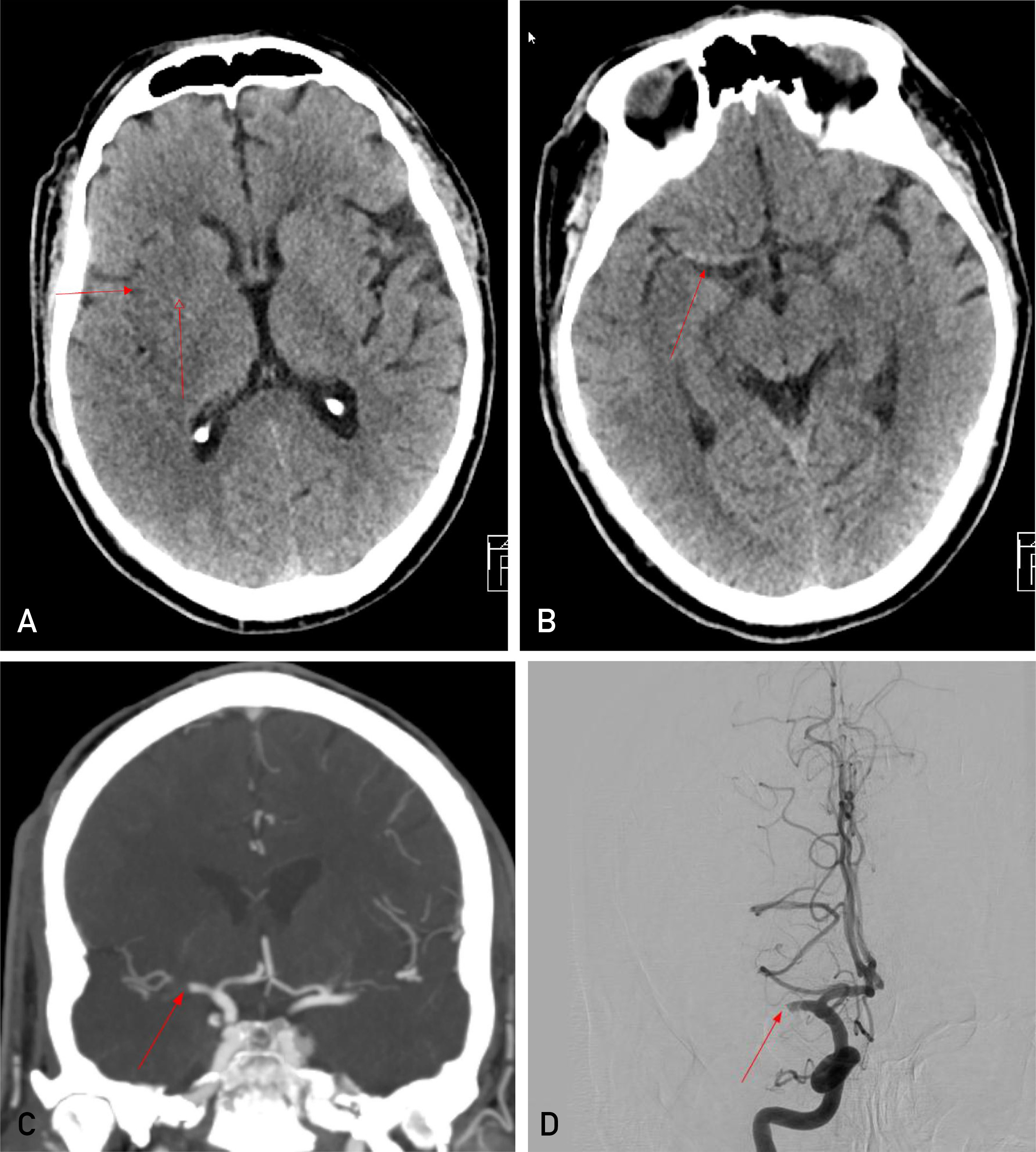 GitHub - ritvik-chebolu/Acute-Ischemic-Stroke-Prediction: This repository has all the required ...