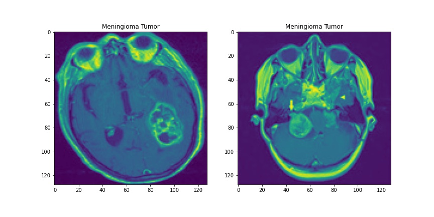 GitHub - ahmedshahjahan/Data-Science-Capstone-Project-Brain-Tumor ...