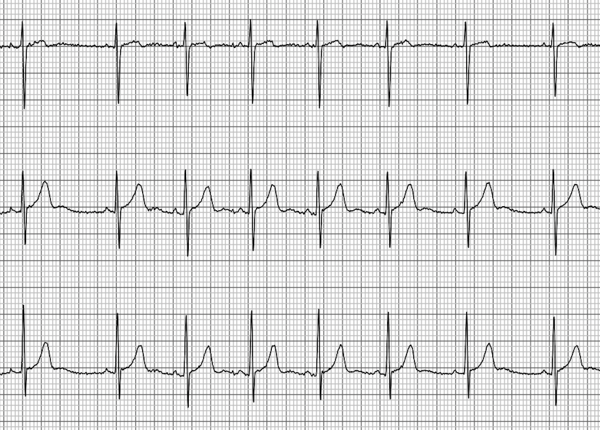 Github Antonior92 Ecg Preprocessing