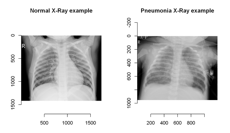 GitHub - juliashal/Pneumonia-Identification-ML: ML models testing on ...
