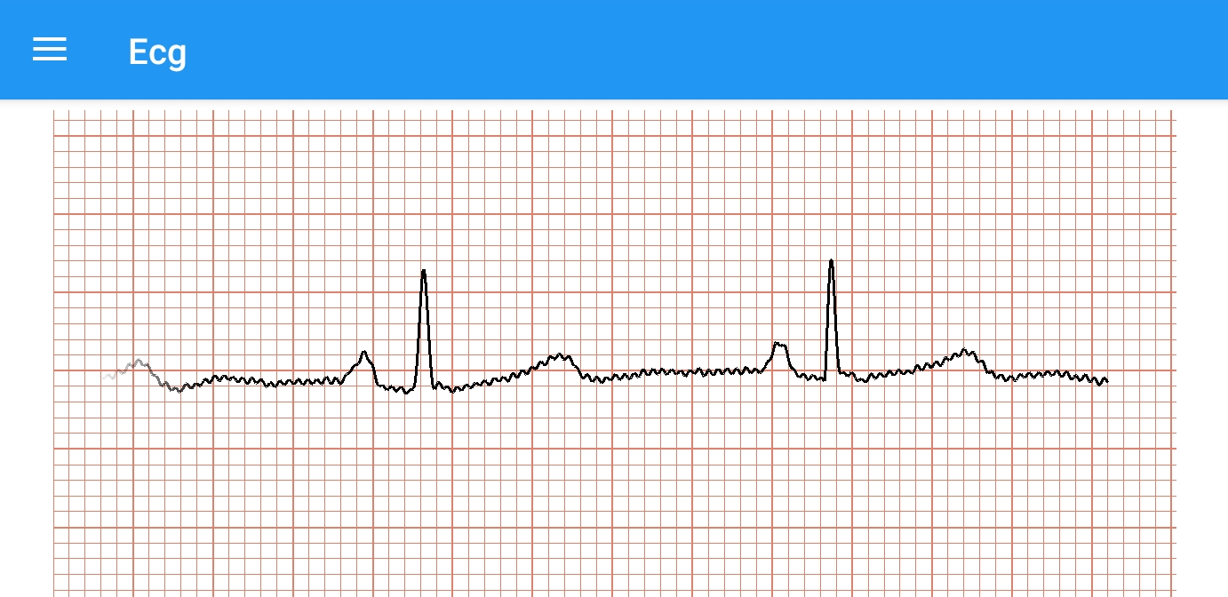 GitHub - tobibodamer/ecg-ble: ECG reading, displaying and logging over ...