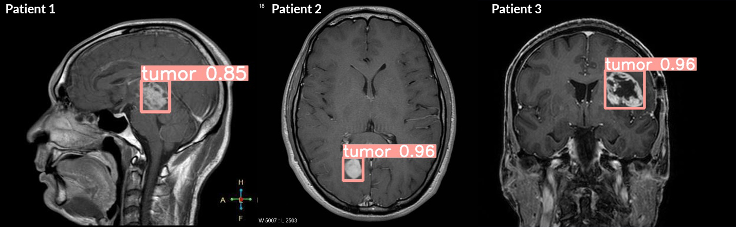 GitHub Giuseppebrb BrainTumorDetection Brain Tumor Detection Using Computer Vision