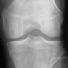 GitHub - AsifIkbal1/-Osteoarthritis-Knee-X-ray: Osteoarthritis Knee X-ray