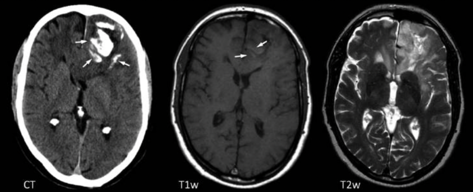 Application Of Ml Models For Brain Cancer Classification Hids509 Finalproject Step1 Ipynb At