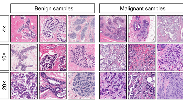 GitHub - natvalenz/breastCancer: The goal of this project is to use ...