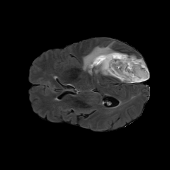 GitHub - Mayo-Radiology-Informatics-Lab/MBTI: Multitask Brain Tumor Inpainting with Diffusion Models