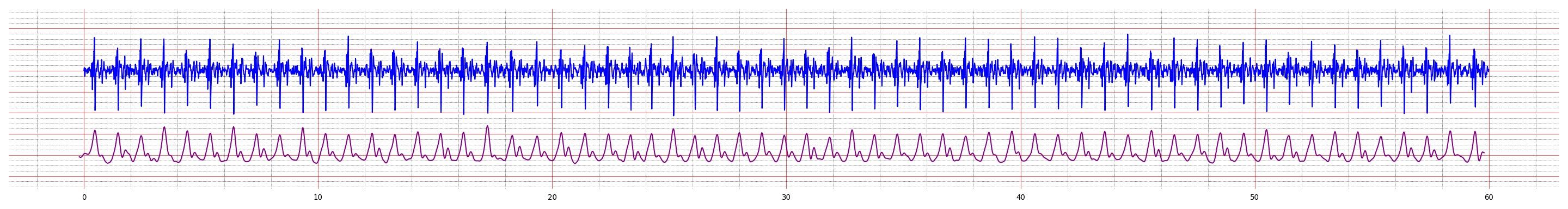 Github Mojjafgyrocardiography Heartbeat Detection This Is A Python Library For Processing 8169