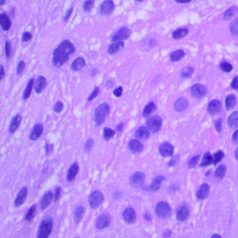 Github Zkadir Lung Cancer Classification