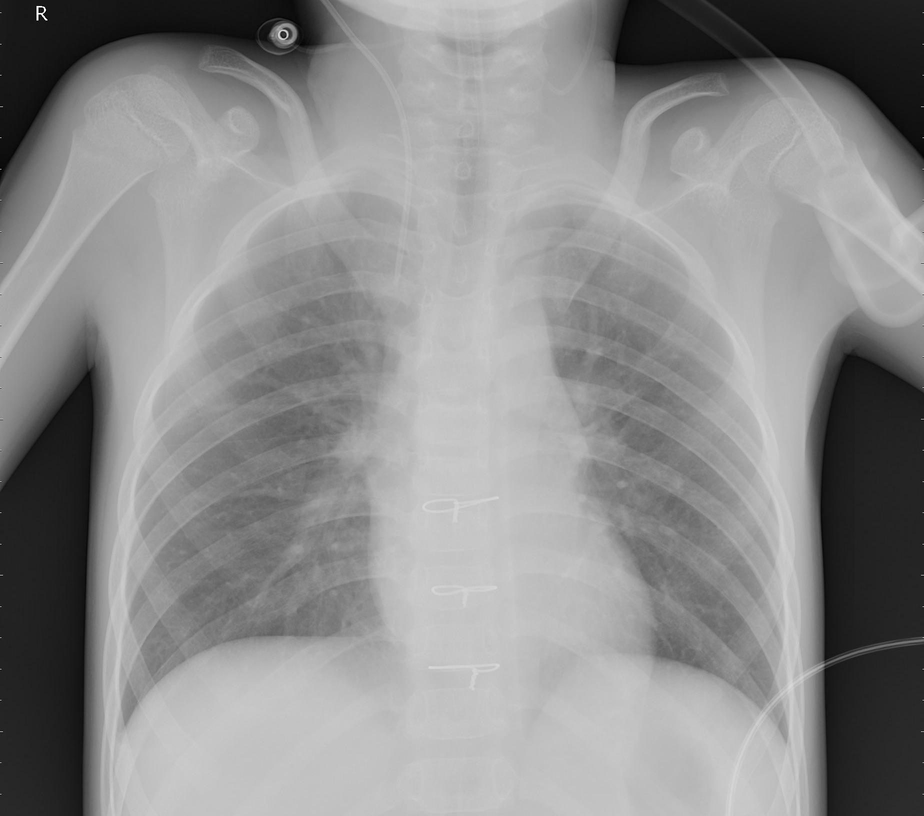 Github Alex Ele Xela Image Analysis Project The Project Repo For Chest X Ray Pneumonia Detection