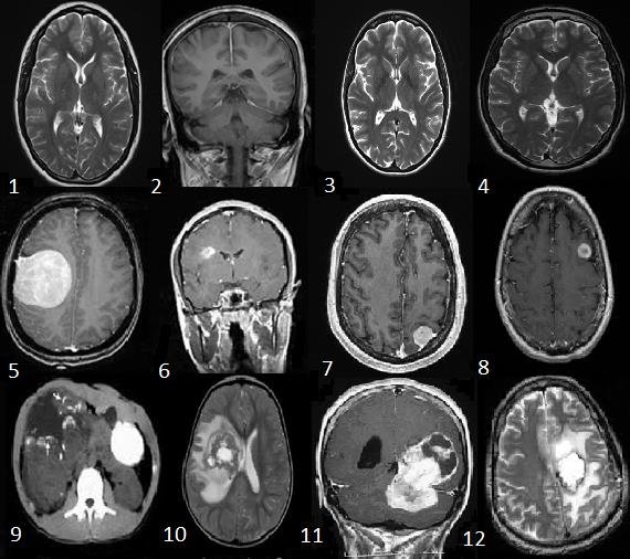 BRAIN-TUMOR-Classification-Task-/BRAIN_TUMOR.ipynb at main ...