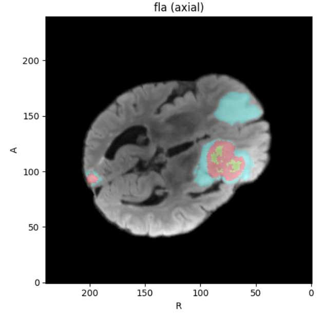 GitHub - anenbergb/mgmt-promoter-methylation: Research towards ...