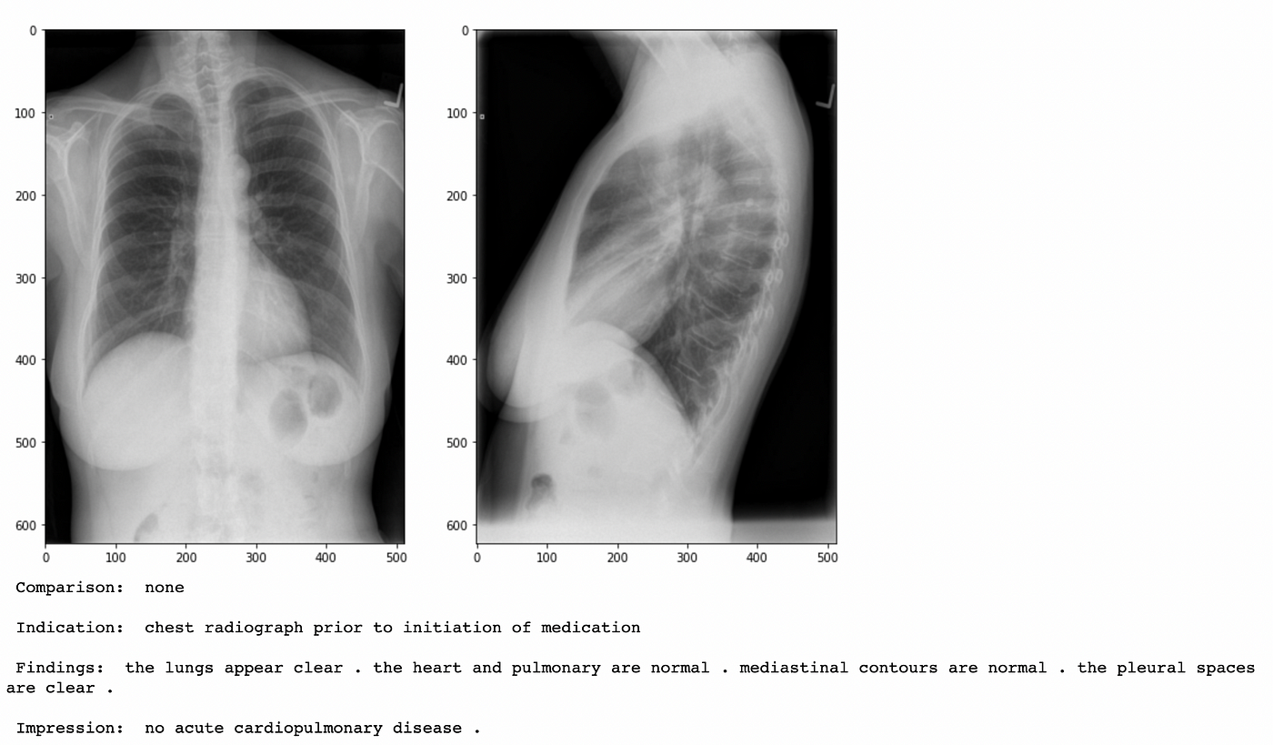 GitHub - AsifIkbal1/Image-Captioning-Chest-X-Rays-: Image Captioning (Chest X-Rays)