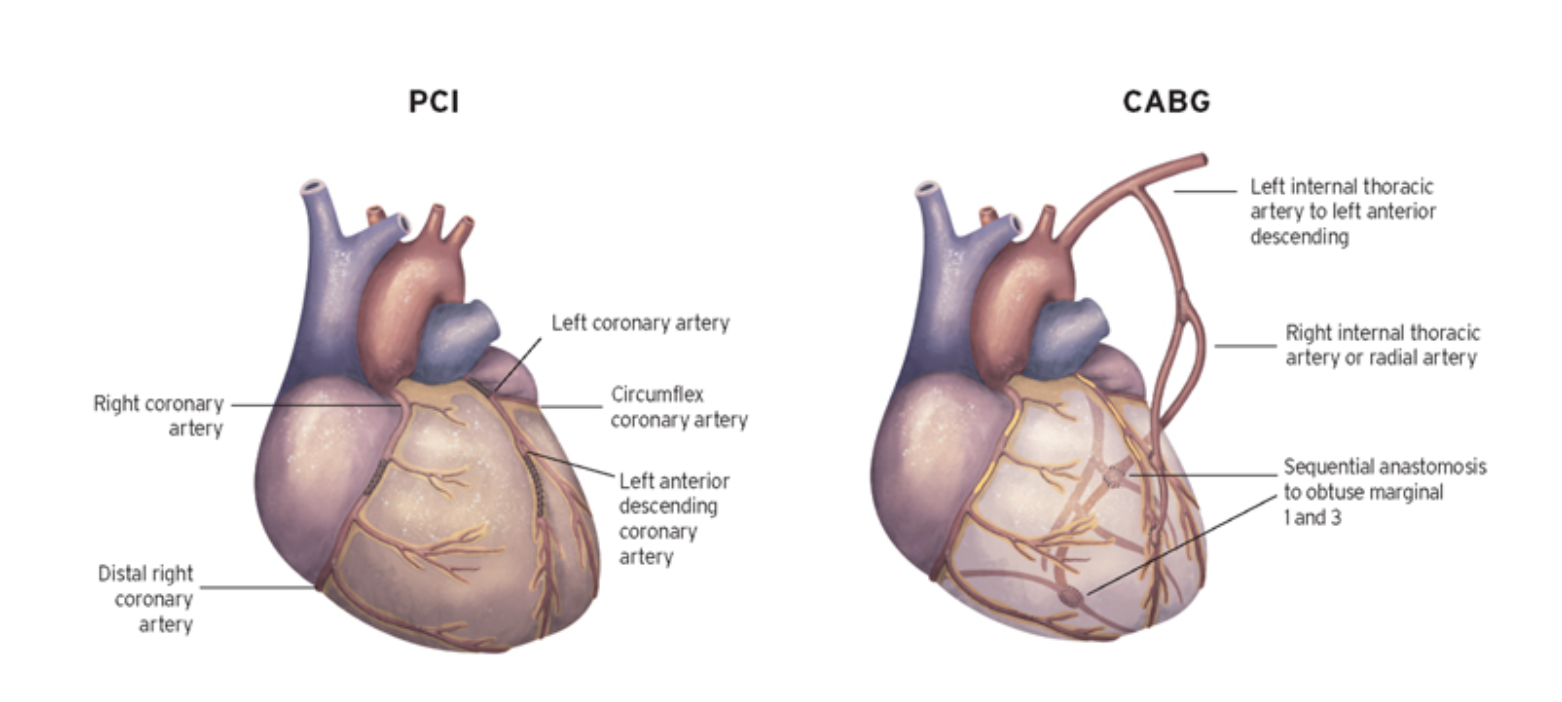 GitHub - samuelheuts/Bayes_in_PCI_vs_CABG